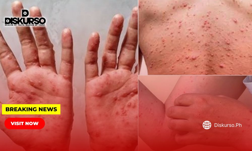 Mpox umatake sa Talisay! Mandaue at Iloilo naka-red alert sa mga bagong ...